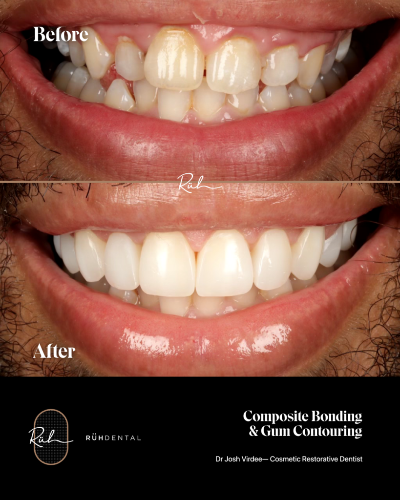 Advantages of Composite Bonding Over Other Dental Procedures | Ruh Dental